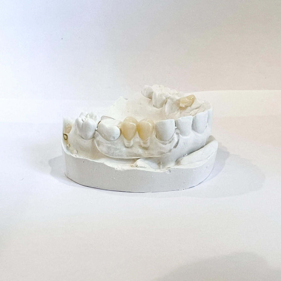 Clear Unilateral Partial Denture: Perfect Fit, Ultimate Comfort