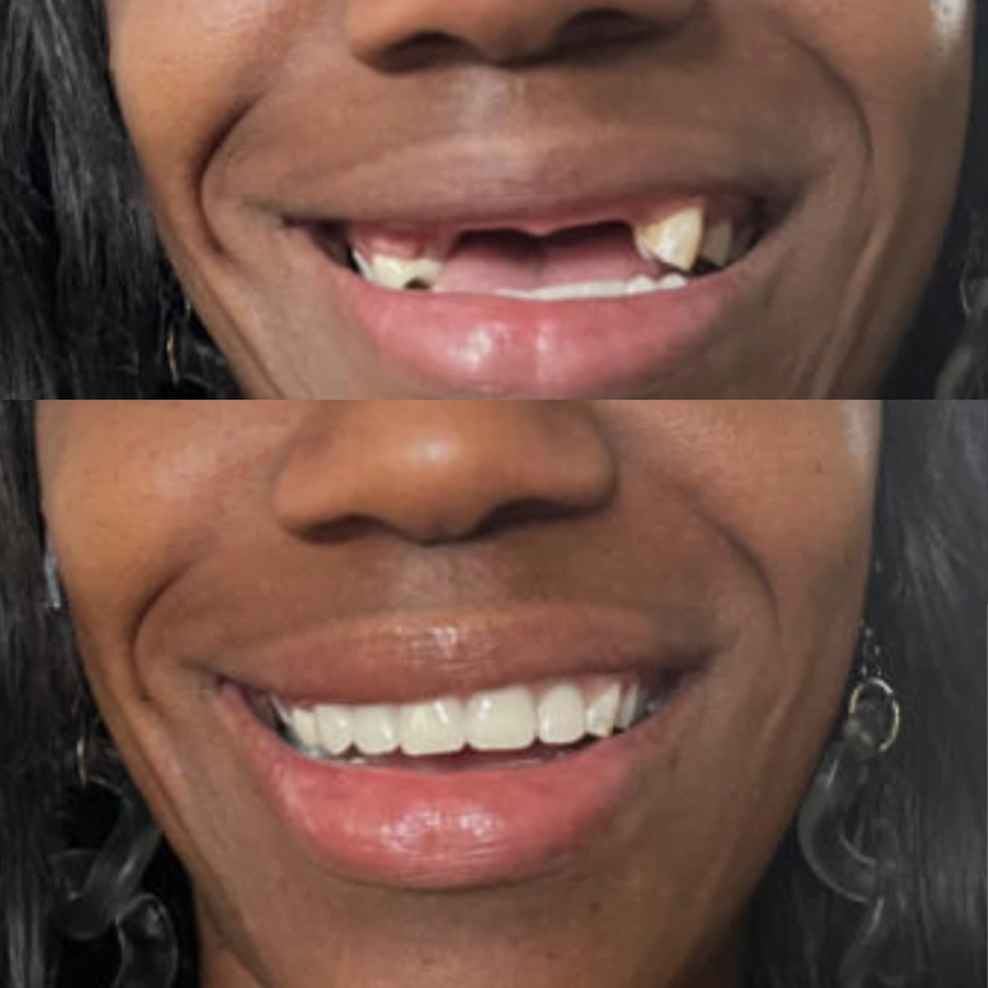 Affordable Unilateral Partial Denture – Restore Your Smile