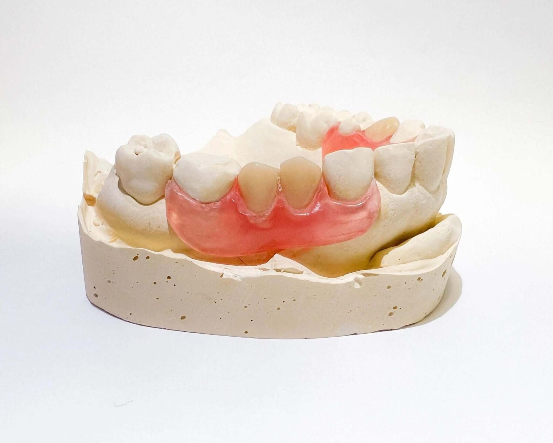 Affordable Unilateral Partial Denture – Restore Your Smile