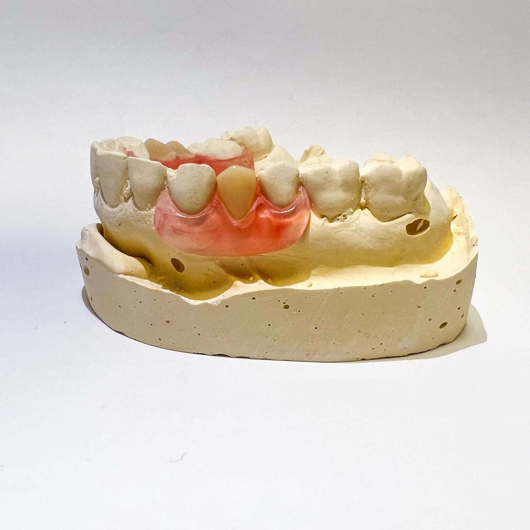 Affordable Unilateral Partial Denture – Restore Your Smile