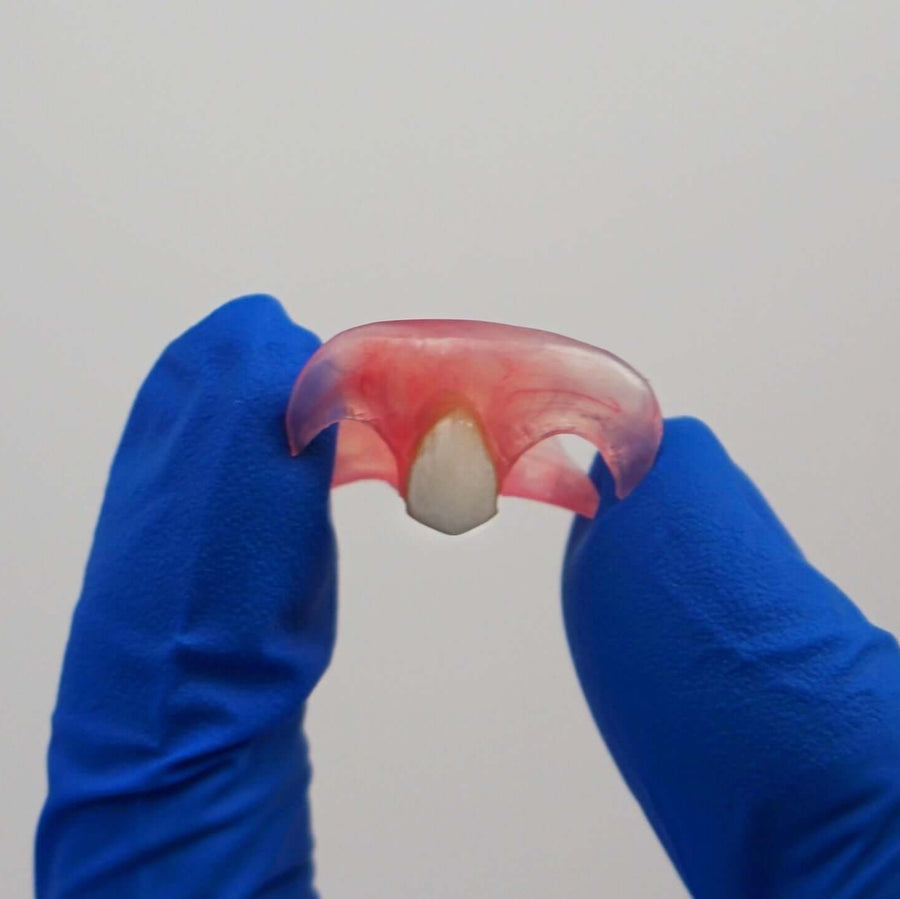 Affordable Unilateral Partial Denture – Restore Your Smile