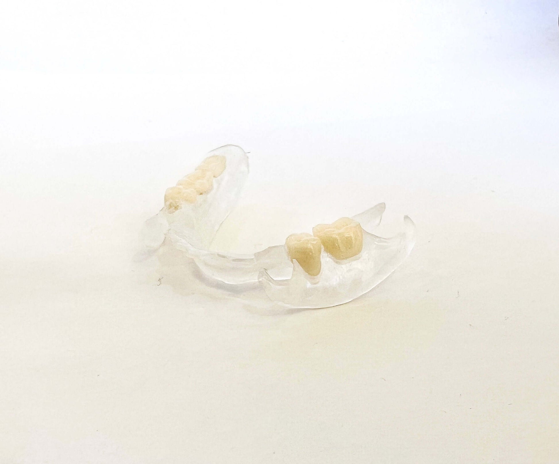 Clear Flexible Partial Denture - Revived Smiles