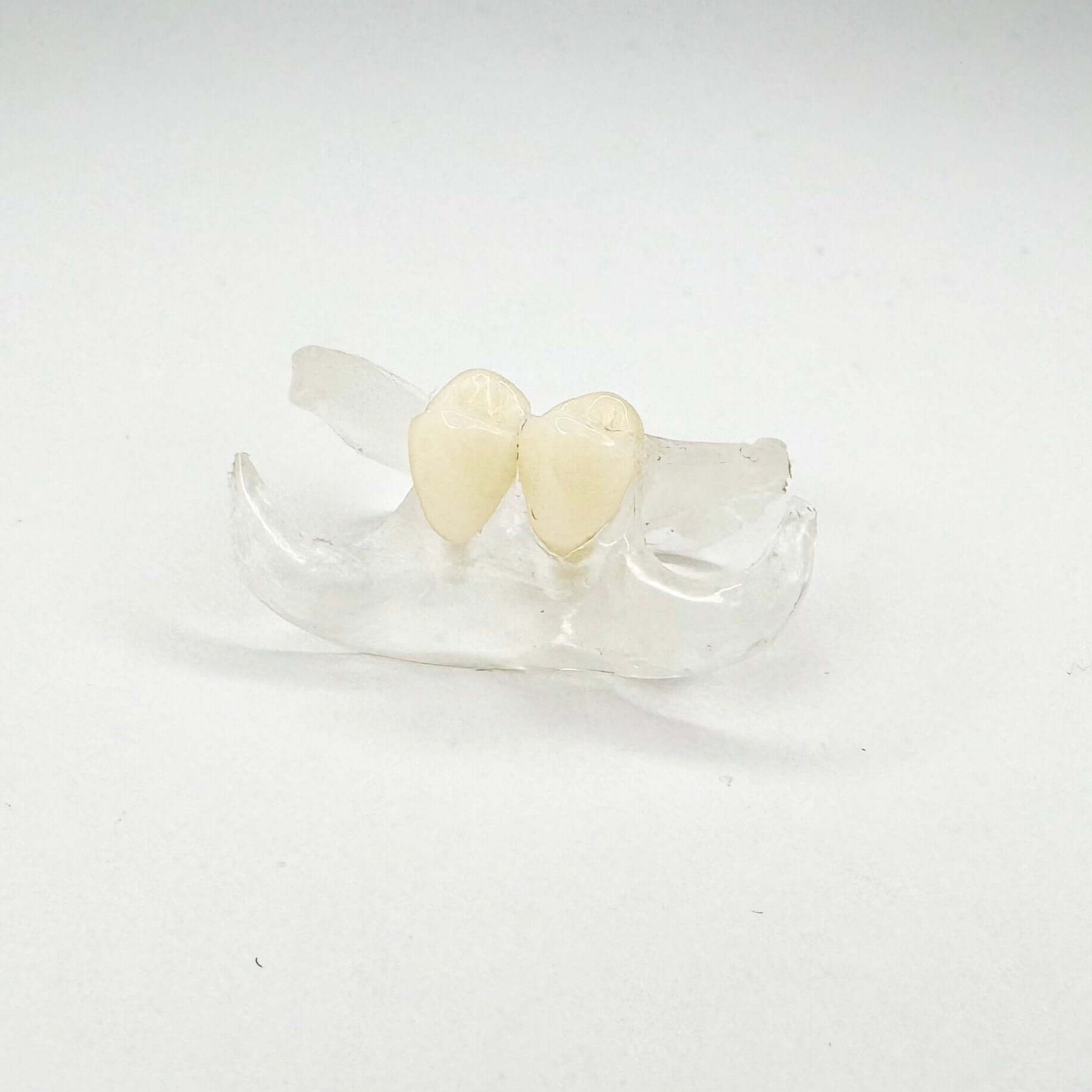 Clear Unilateral Partial Denture: Perfect Fit, Ultimate Comfort